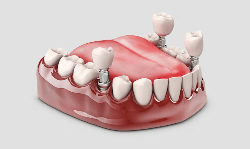 Creating Natural Smiles: Dental Implants Revealed