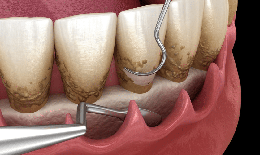 Your Guide to Post-Periodontal Surgery Care
