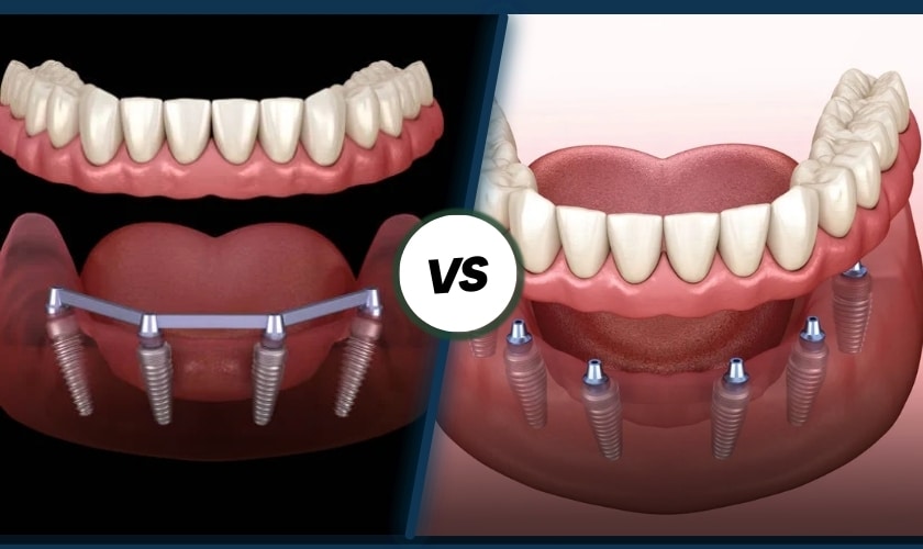 All-on-4 vs. All-on-6 Implants: Which Is Better for You?
